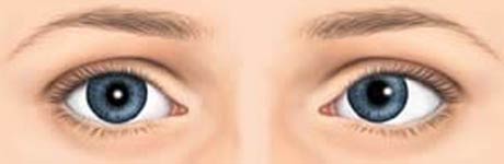 Squint Treatment and Surgery – Bansal Eye Hospital, Yamunanagar-Jagadhri