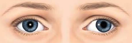 Squint Treatment and Surgery – Bansal Eye Hospital, Yamunanagar-Jagadhri