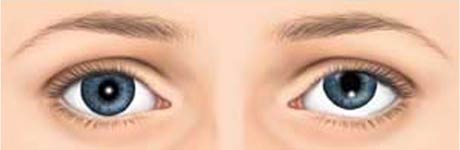 Squint Treatment and Surgery – Bansal Eye Hospital, Yamunanagar-Jagadhri